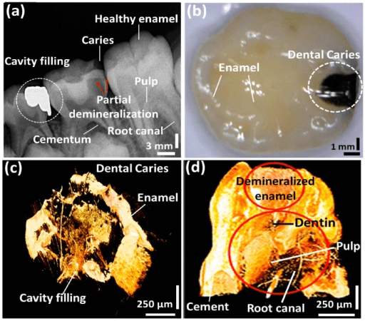 WHAT IS A TOOTH CAVITY? - Pathosomes