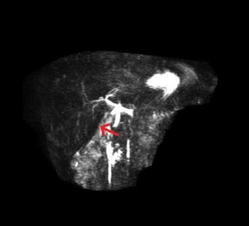 What is Absent Gallbladder? - Pathosomes