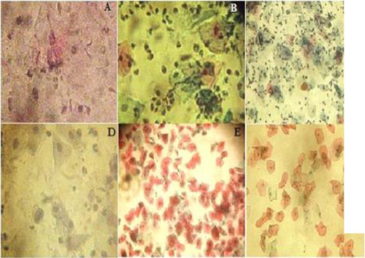 What is Acute Cervicitis? - Pathosomes