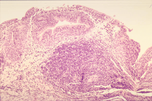 What is Acute Cystitis? - Pathosomes