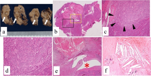 What is Acute Pancreatitis? - Pathosomes