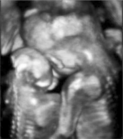 What is Anencephaly? - Pathosomes