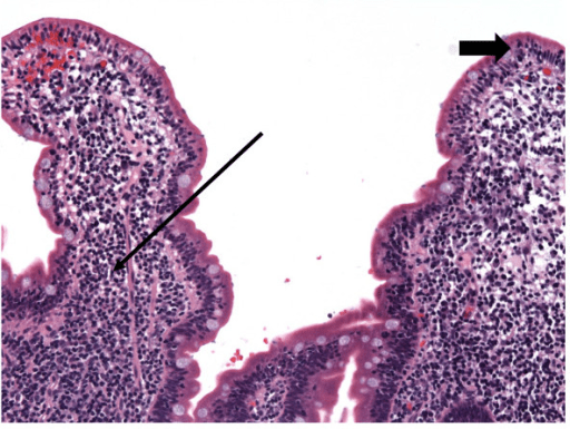 What is Autoimmune Enteropathy? - Pathosomes