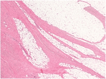 What are Benign Smooth Muscle Soft Tissue Tumors? - Pathosomes