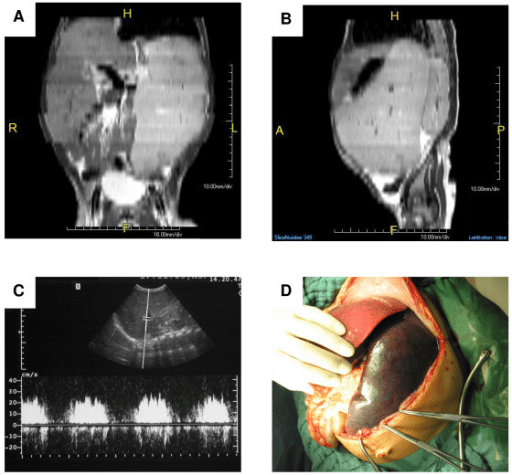 WHAT IS CONGESTIVE SPLENOMEGALY? - Pathosomes