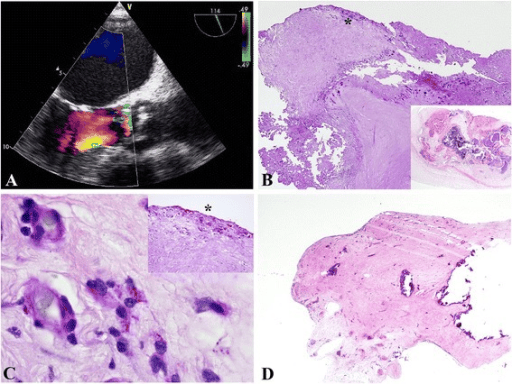 What Is Calcific Valvular Degeneration Pathosomes