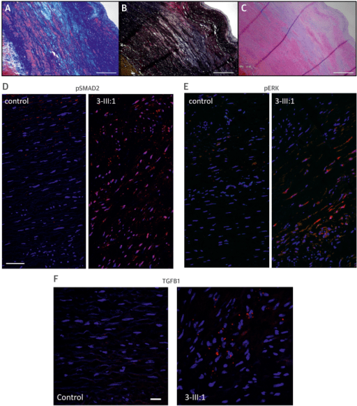 What is Cardiovascular Pathology? - Pathosomes