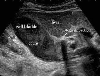 What is Cholecystitis? - Pathosomes