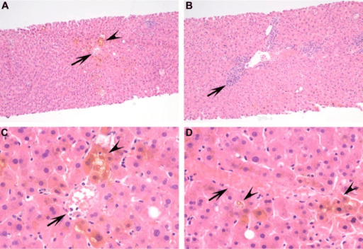 What is Cholestasis? - Pathosomes