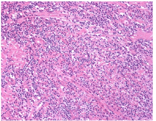 What is Chronic Abacterial Prostatitis? - Pathosomes