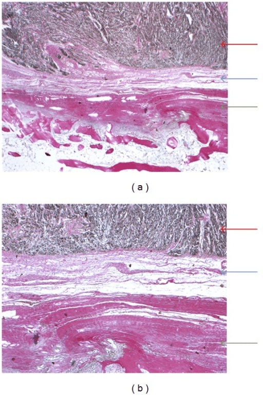what-is-clear-cell-sarcoma-pathosomes