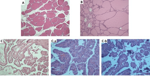 What are Diffuse Goiters? - Pathosomes