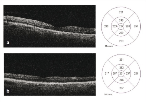 What is End Stage Eye? - Pathosomes