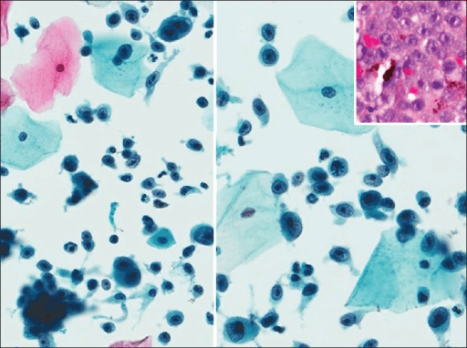 What are Endocervical Polyps? - Pathosomes