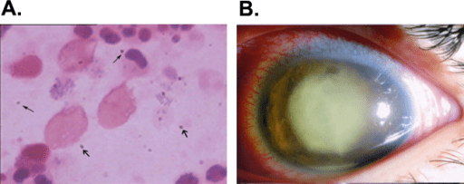What is Endophthalmitis? - Pathosomes