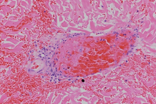 What is Endothelial Cell Damage? - Pathosomes