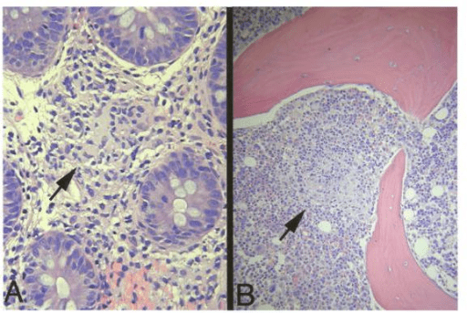 What is Enteritis Associated Arthritis? - Pathosomes