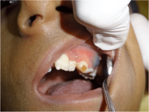 What is an Eruption Cyst? - Pathosomes