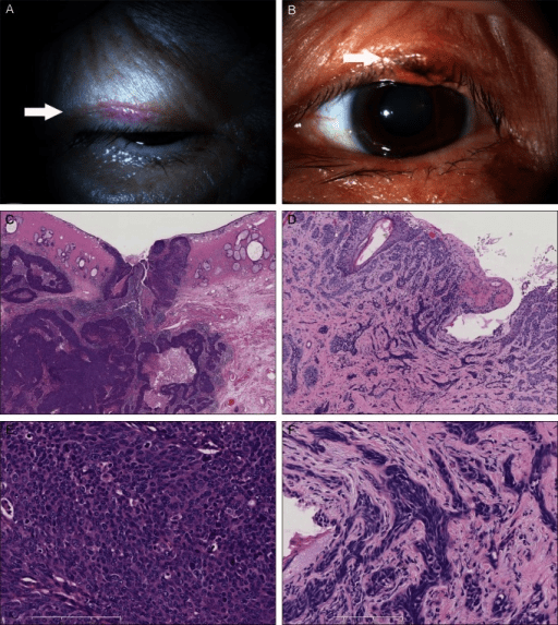 What are Eyelid Neoplasms? - Pathosomes