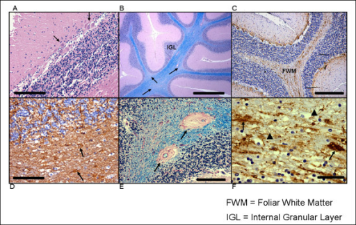 What is Fragile X Syndrome? - Pathosomes