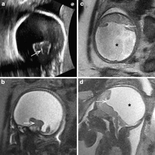 What are Forebrain Anomalies? - Pathosomes