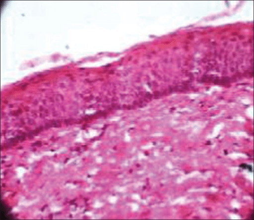 What is Gorlin Syndrome? - Pathosomes