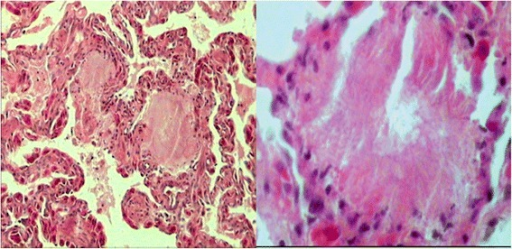 What is Gout? - Pathosomes