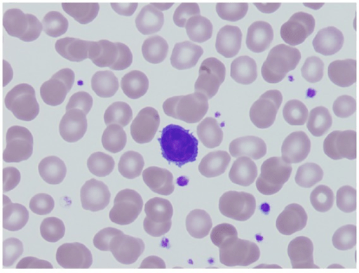What is Hairy Cell Leukemia? - Pathosomes