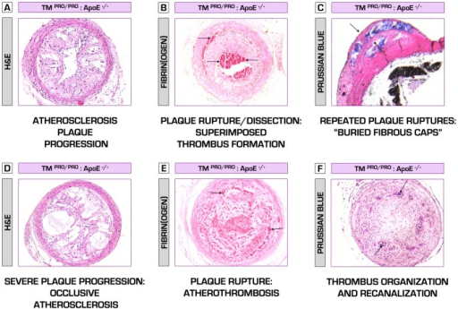 What is a Hypercoagulable State? - Pathosomes