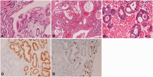 What are Hyperplastic Polyps? - Pathosomes