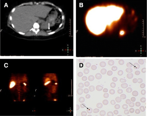 What is Hyposplenia? - Pathosomes