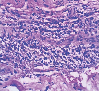 What is Infectious Arthritis? - Pathosomes
