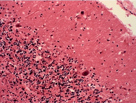 What is Kuru? - Pathosomes