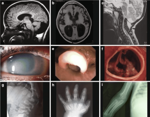 What are Lysosomal Storage Diseases? - Pathosomes