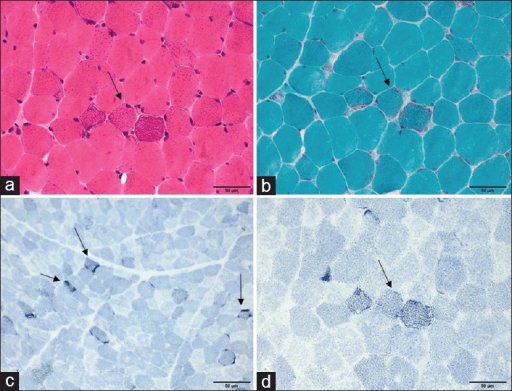 Skeletal Muscle Pathology Study Guide - Pathosomes