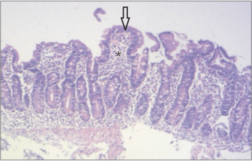 What is Malabsorption? - Pathosomes