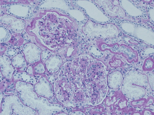 What is Malignant Nephrosclerosis? - Pathosomes