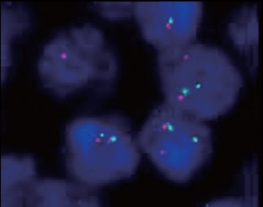 What is Mantle Cell Lymphoma? - Pathosomes