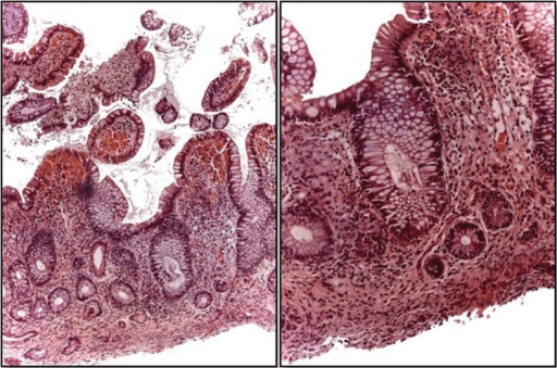 What is Mucosal Atrophy? - Pathosomes