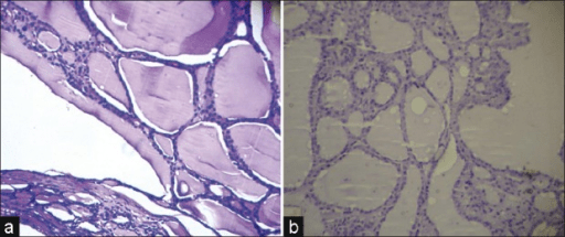 What is a Multinodular Goiter? - Pathosomes