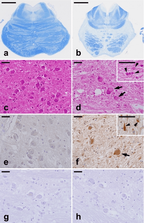 What is Multiple System Atrophy? - Pathosomes