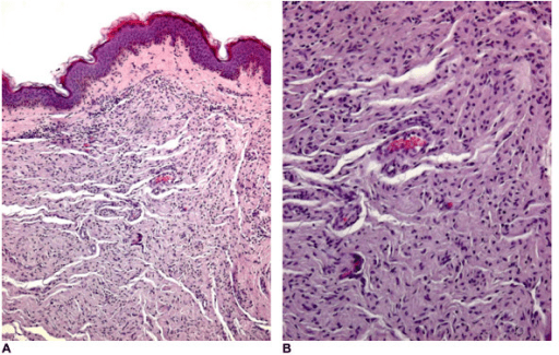 What is a Neurofibroma? - Pathosomes