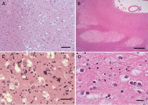 What are Neuronal Tumors? - Pathosomes