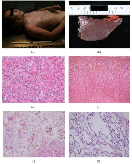 What is Nonspecific Acute Splenitis? - Pathosomes