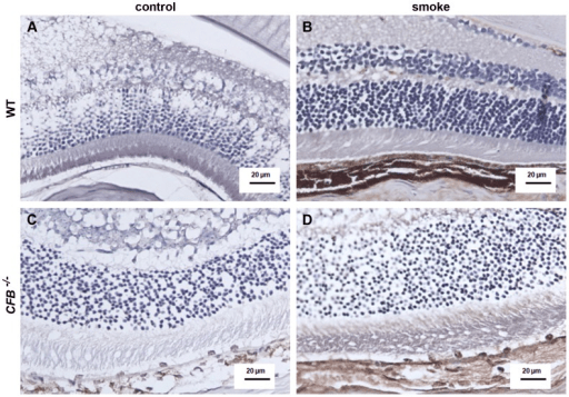 WHAT IS OCULAR PATHOLOGY? - Pathosomes