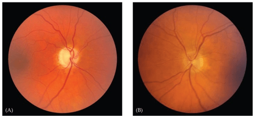 What is Optic Neuritis? - Pathosomes
