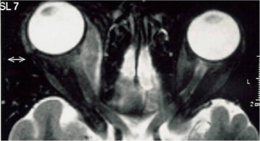 What is Proptosis? - Pathosomes