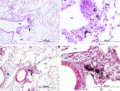 WHAT IS PULMONARY PATHOLOGY? - Pathosomes
