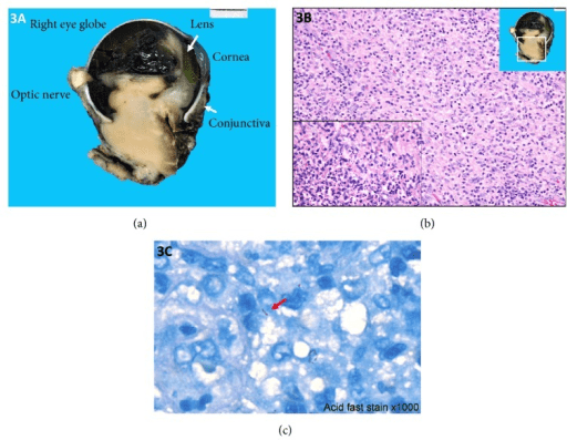 What is Panophthalmitis? - Pathosomes