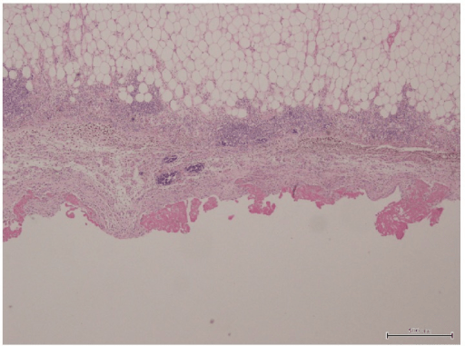 What is Pericarditis? - Pathosomes
